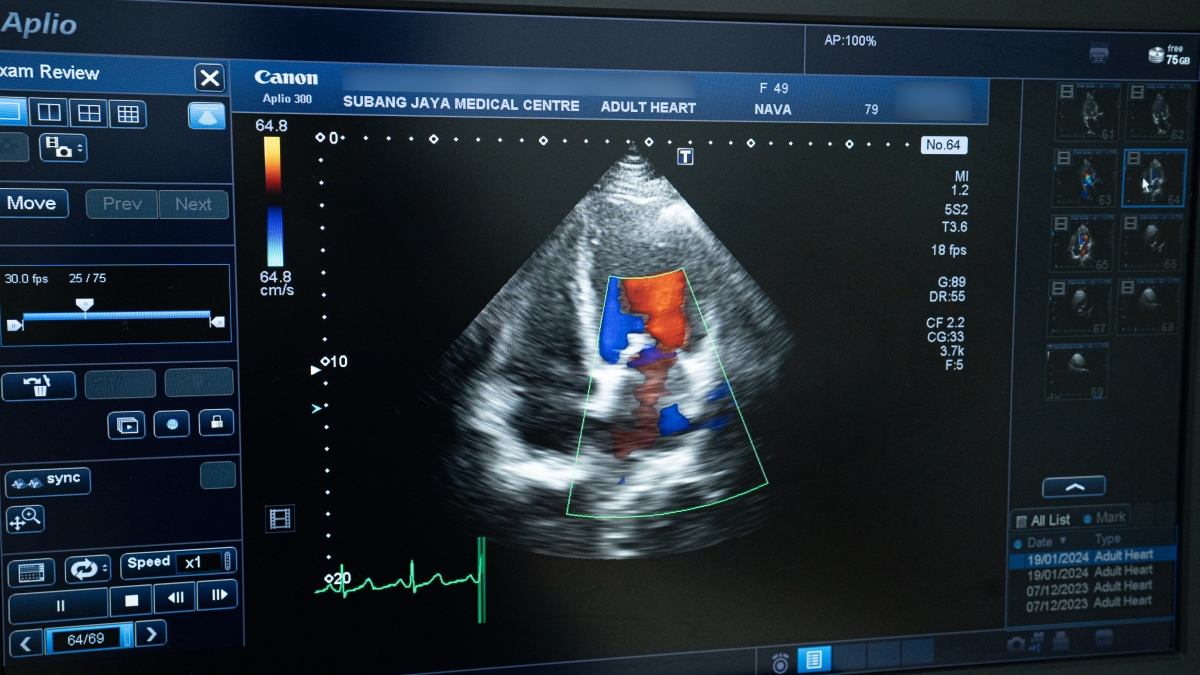 We talk to an electrophysiologist about heart arrhythmia